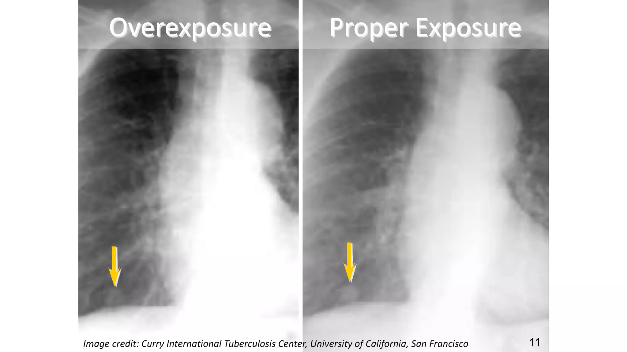 Chest X ray ppt.ppt