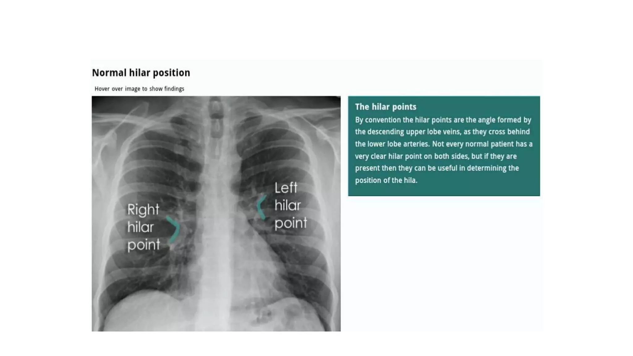 Chest X ray ppt.ppt