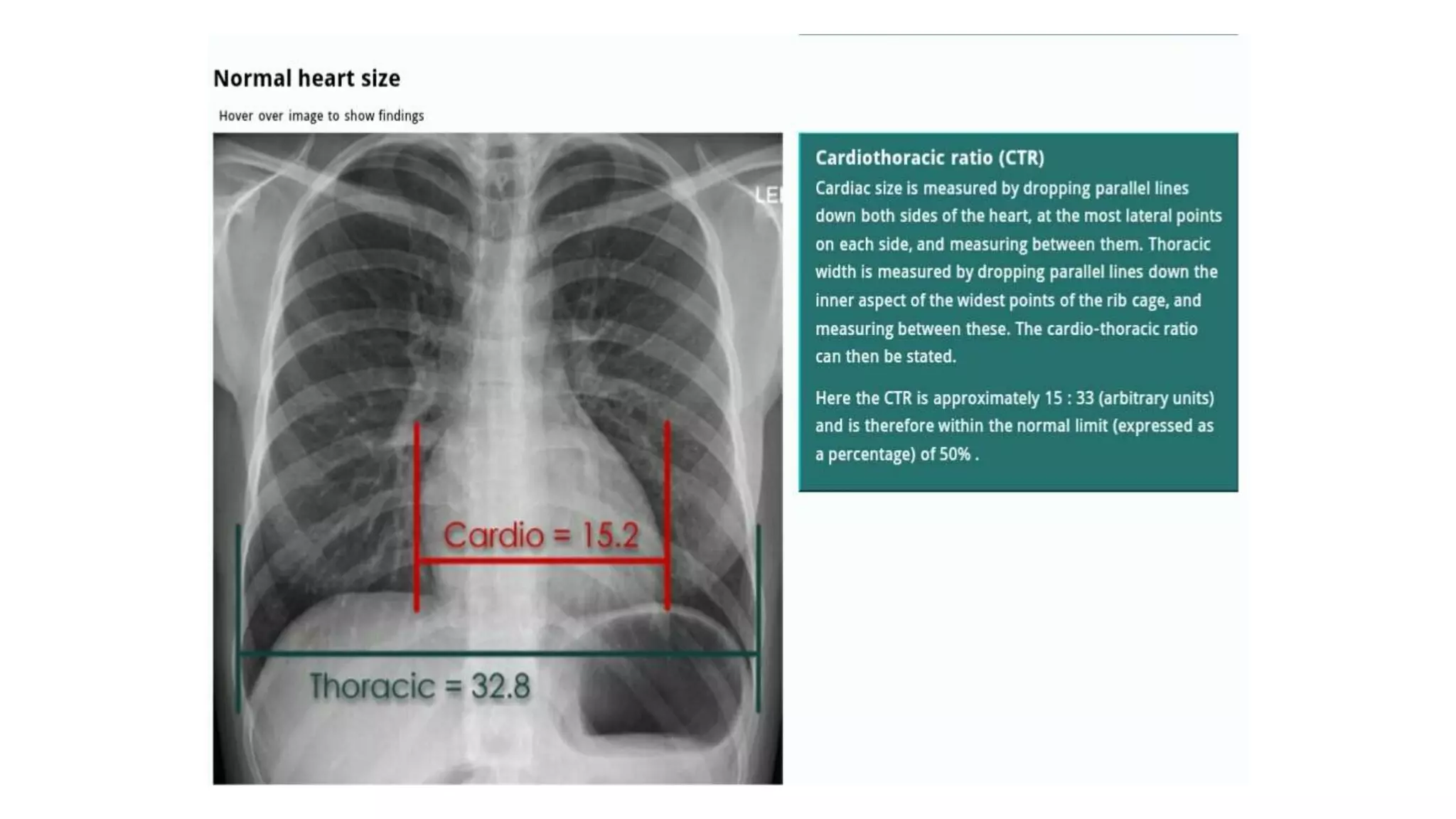 Chest X ray ppt.ppt
