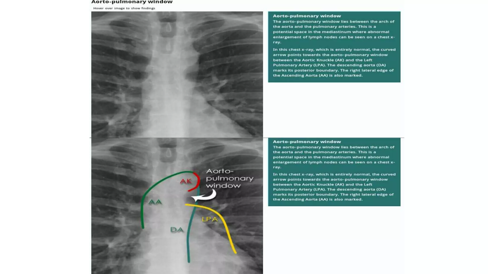 Chest X ray ppt.ppt