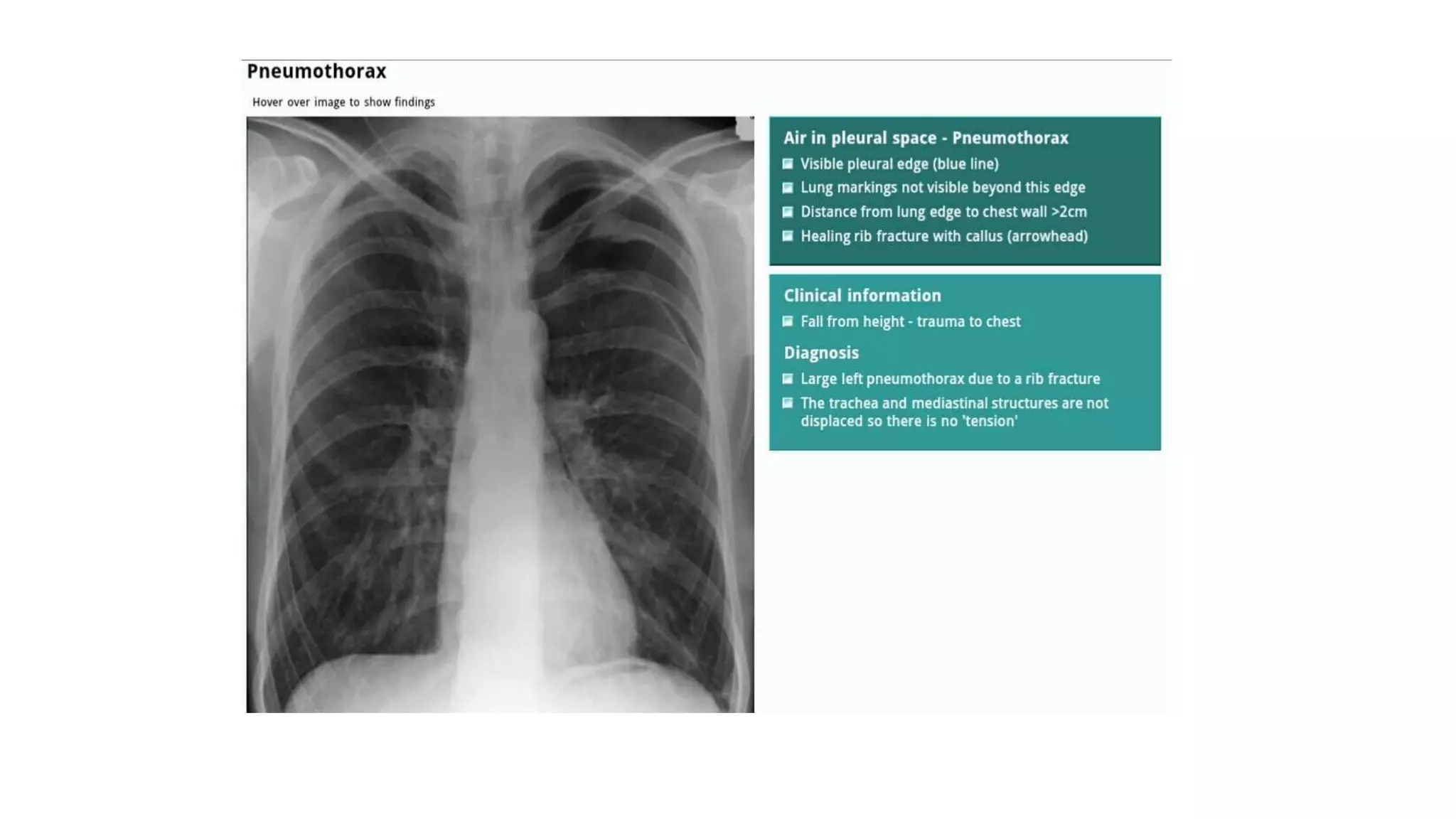 Chest X ray ppt.ppt