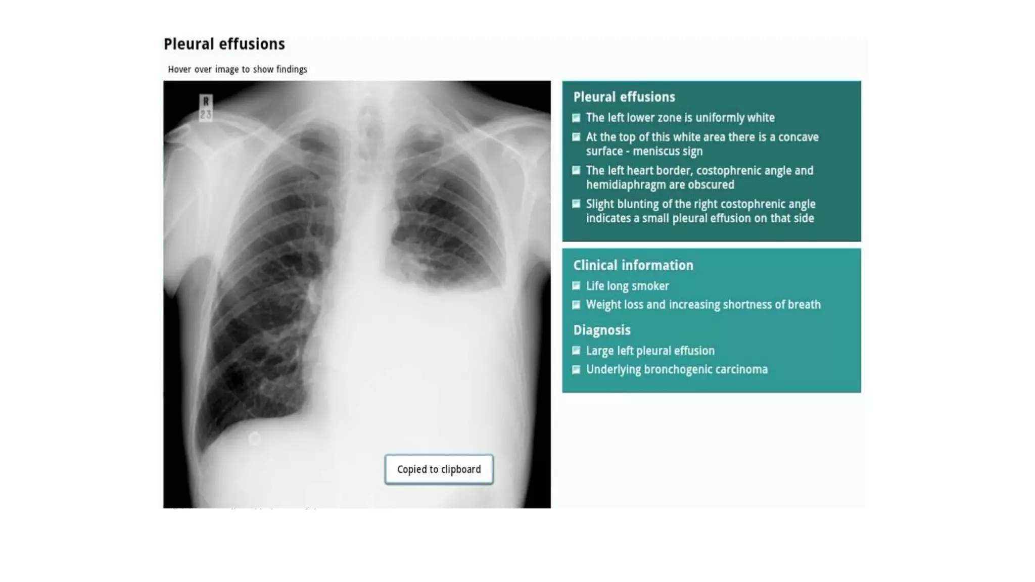 Chest X ray ppt.ppt