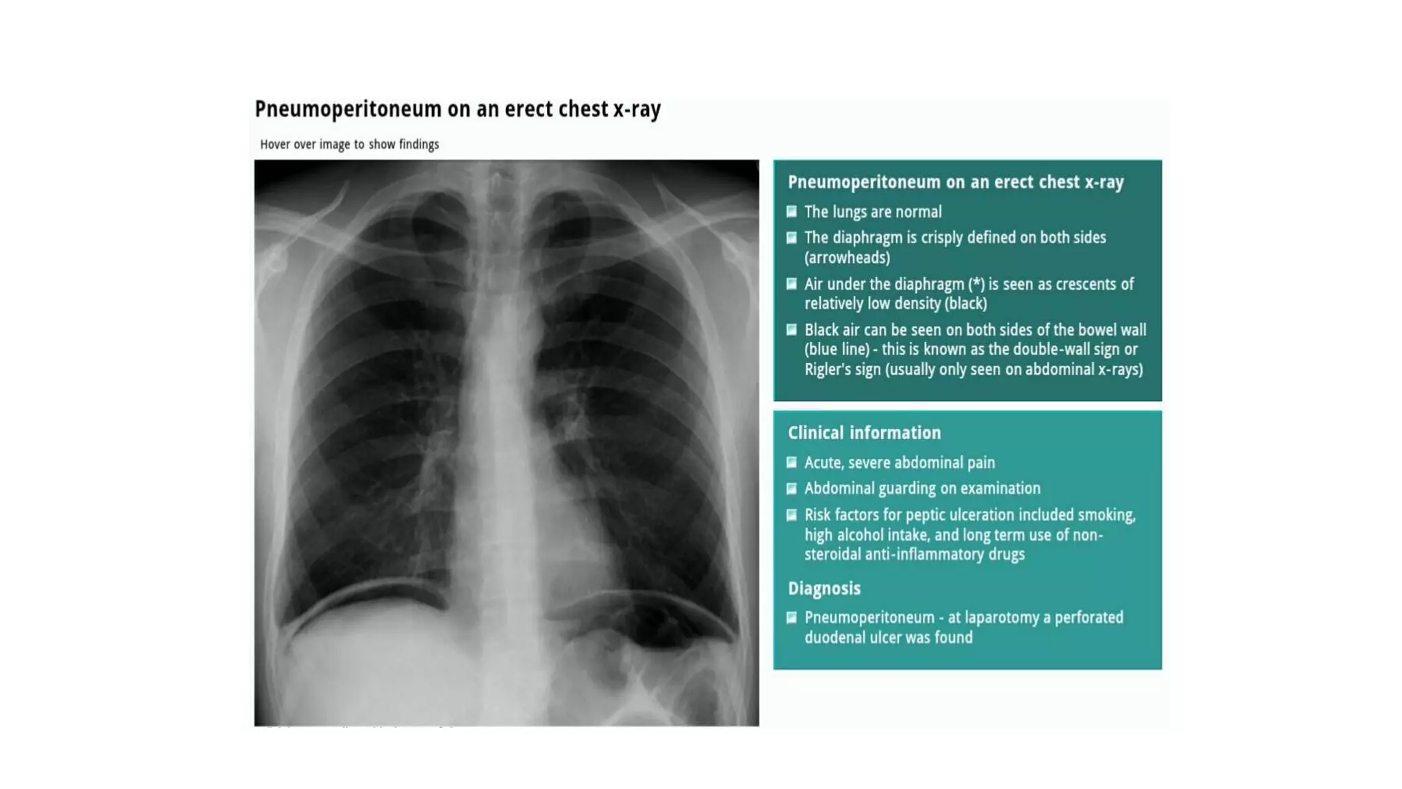 Chest X ray ppt.ppt