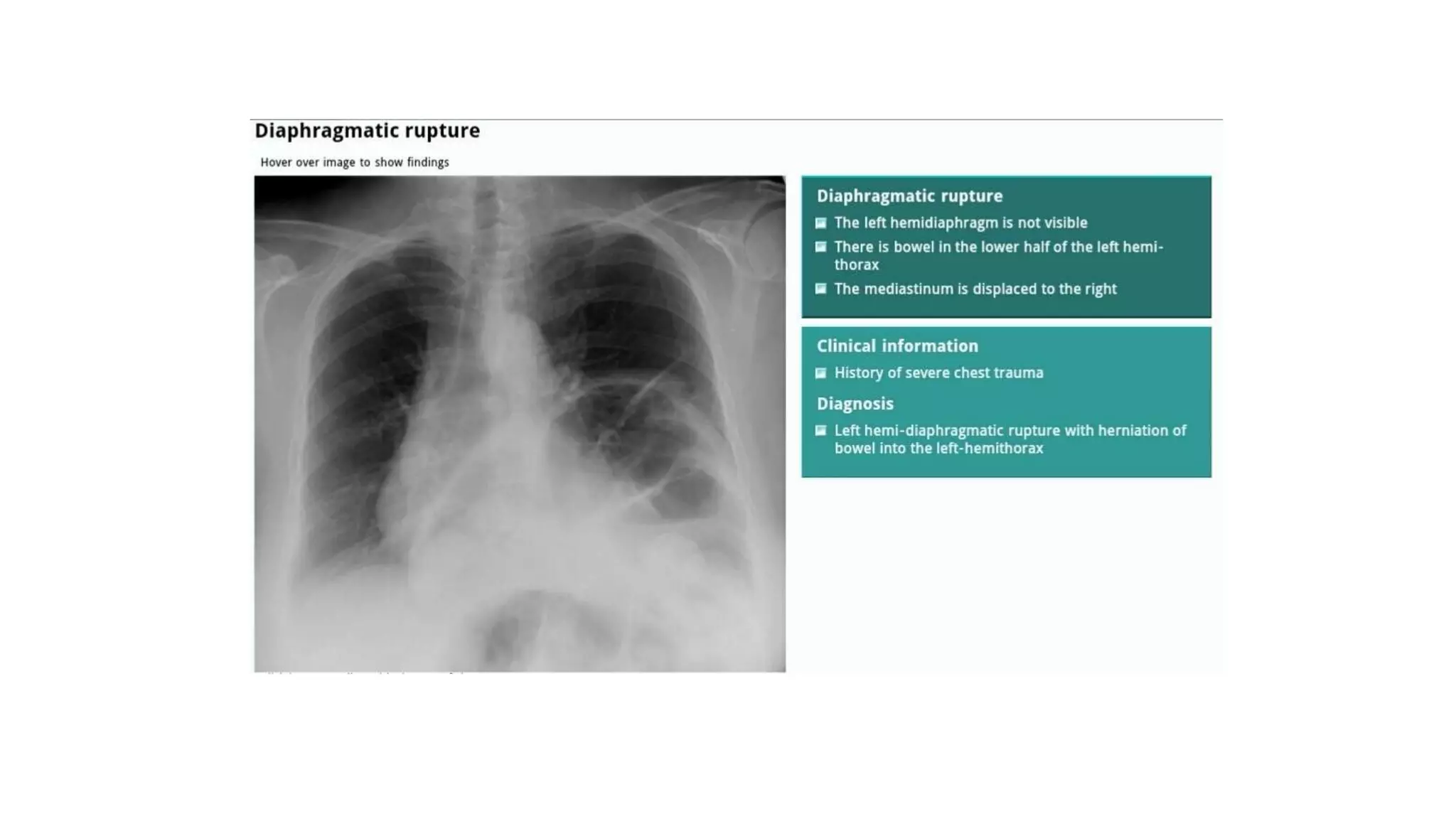 Chest X ray ppt.ppt