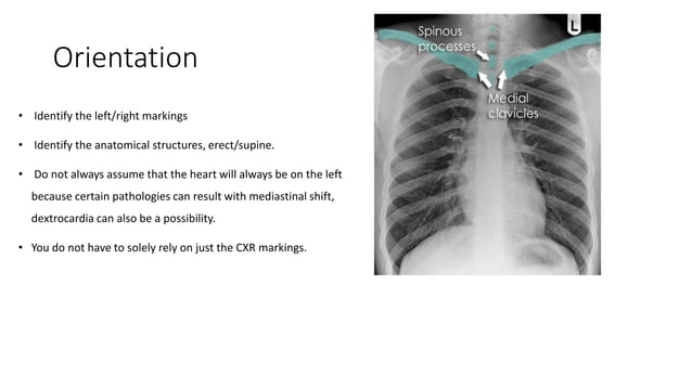 Chest X ray ppt.ppt
