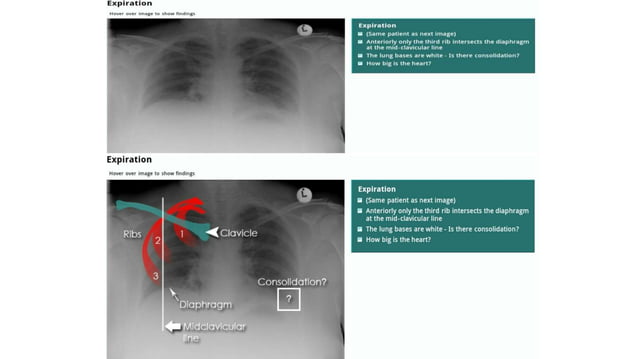 Chest X ray ppt.ppt