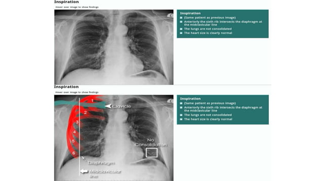 Chest X ray ppt.ppt