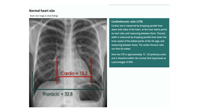 Chest X ray ppt.ppt