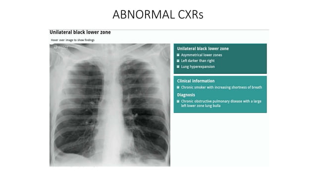 Chest X ray ppt.ppt