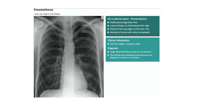 Chest X ray ppt.ppt