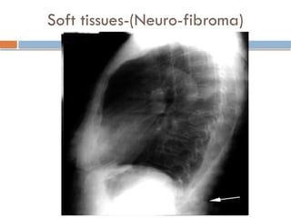 Chest X Ray interpretation Felson radiology.pptx