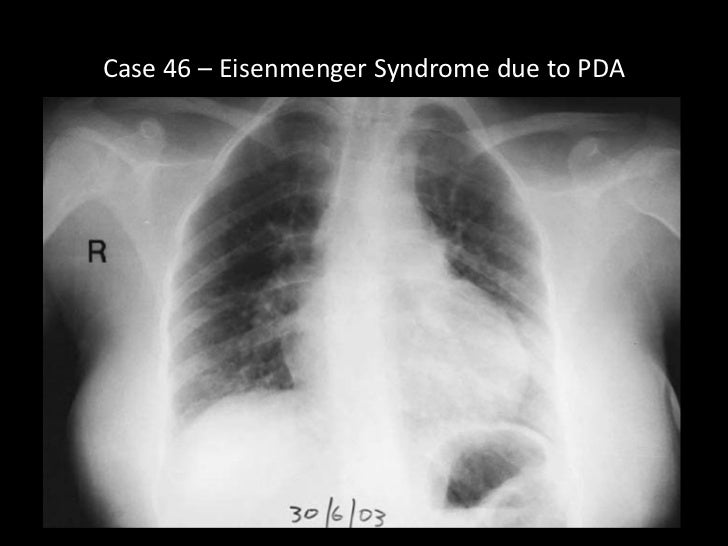 Chest X Rays