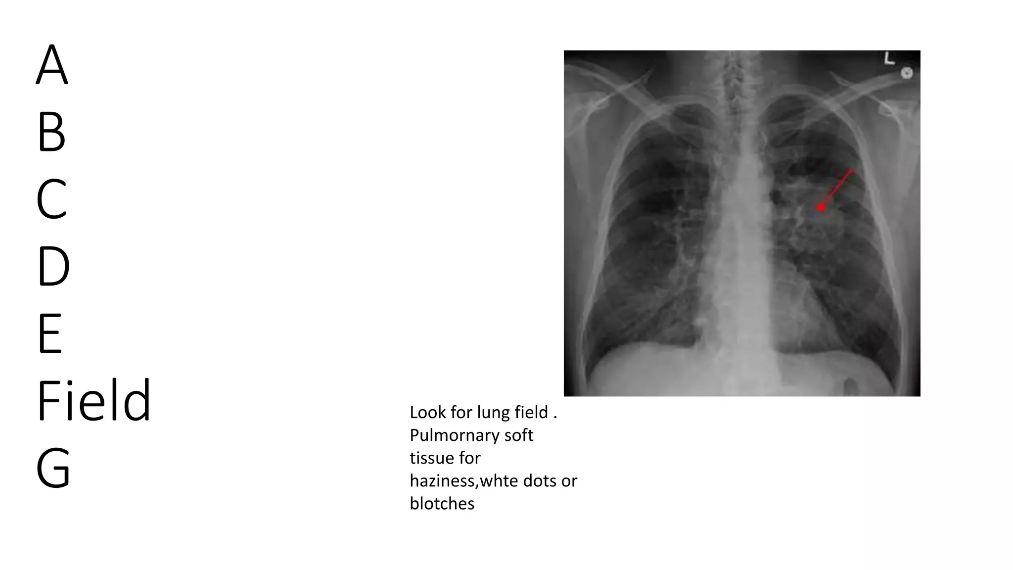Chest xrays how to interpret. photos | PPT