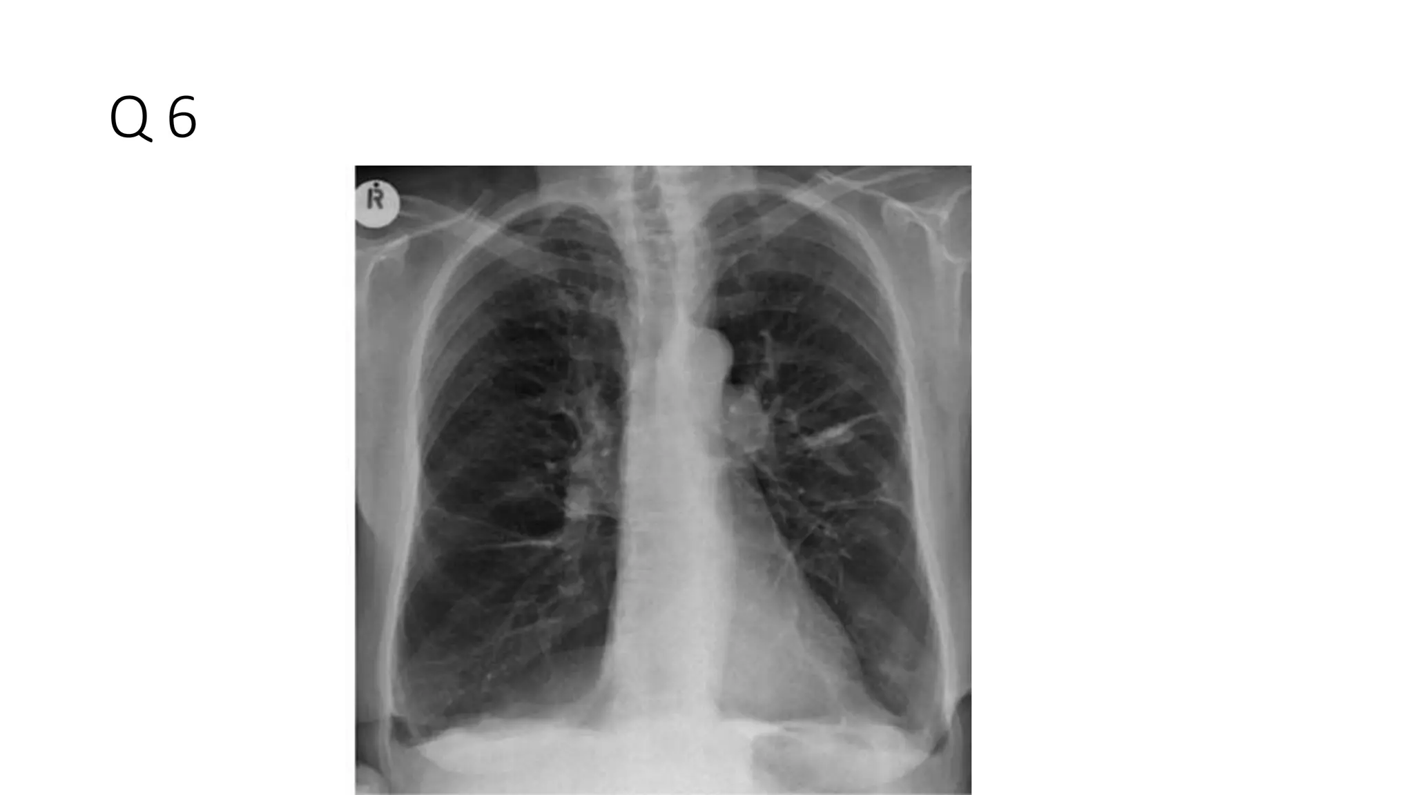 Chest xrays how to interpret. photos | PPT