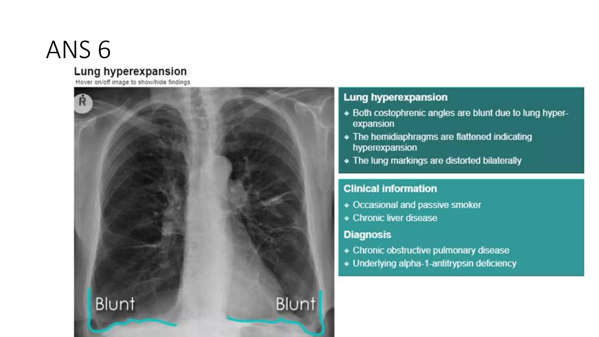 Chest xrays how to interpret. photos | PPT