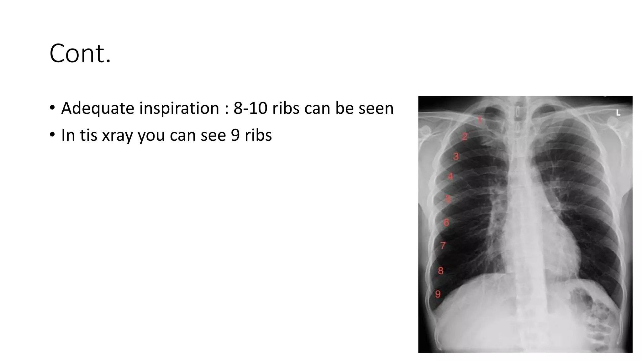 Chest xrays how to interpret. photos | PPT