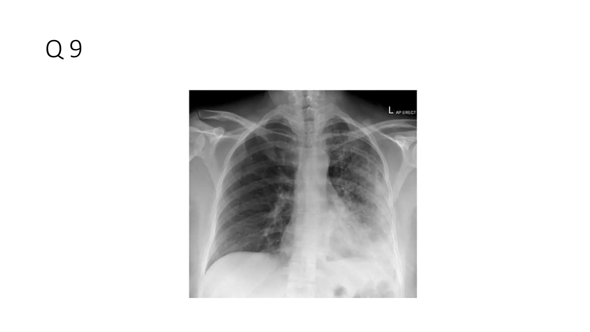 Chest xrays how to interpret. photos | PPT