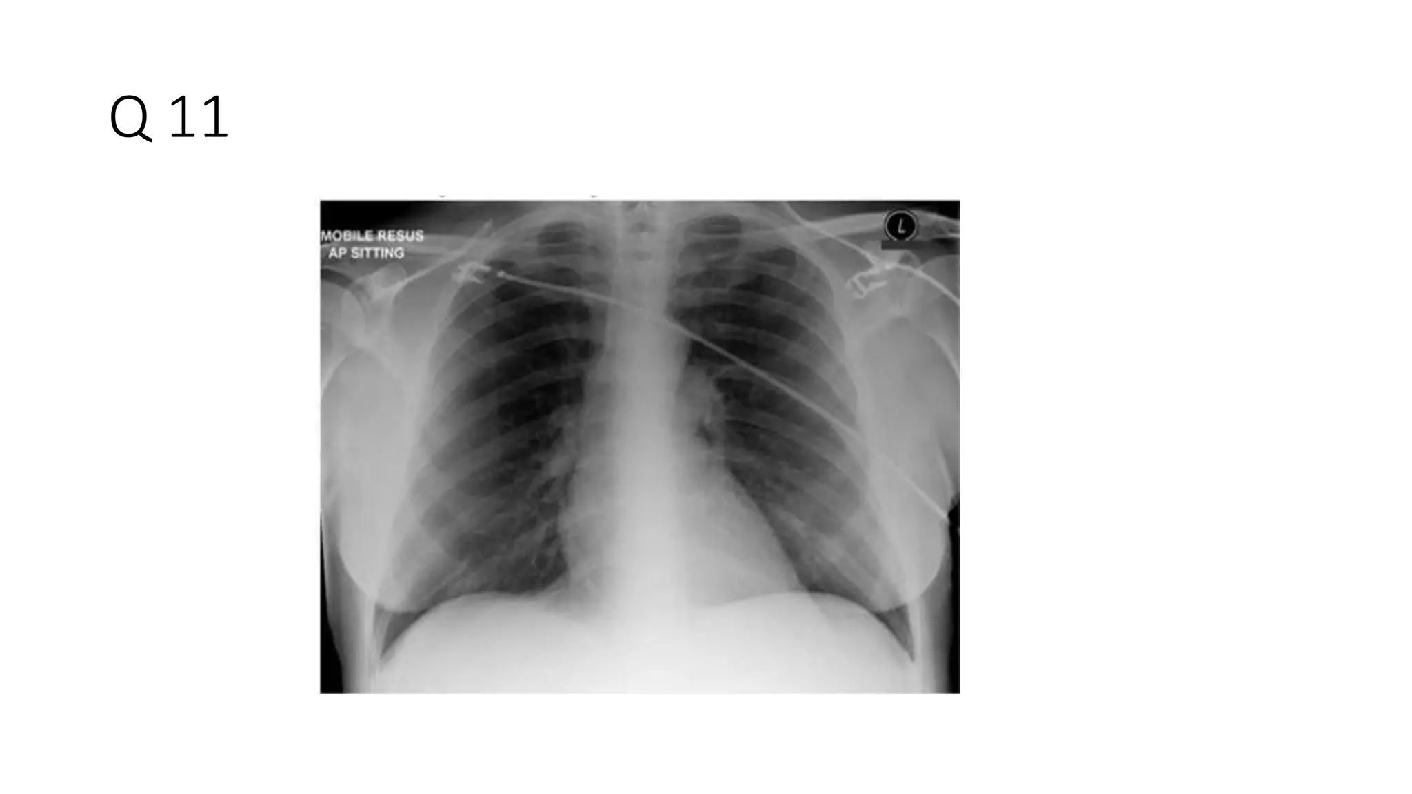 Chest xrays how to interpret. photos | PPT
