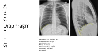 Chest xrays how to interpret. photos | PPTX