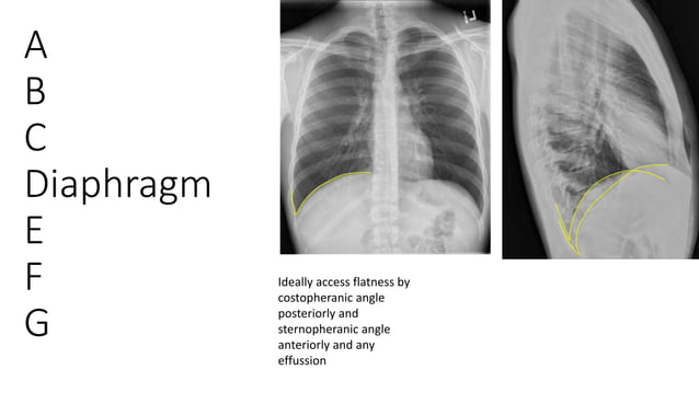 Chest xrays how to interpret. photos | PPT