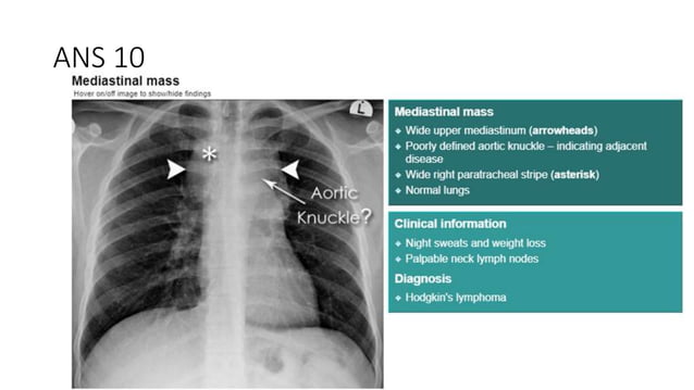 Chest xrays how to interpret. photos | PPT