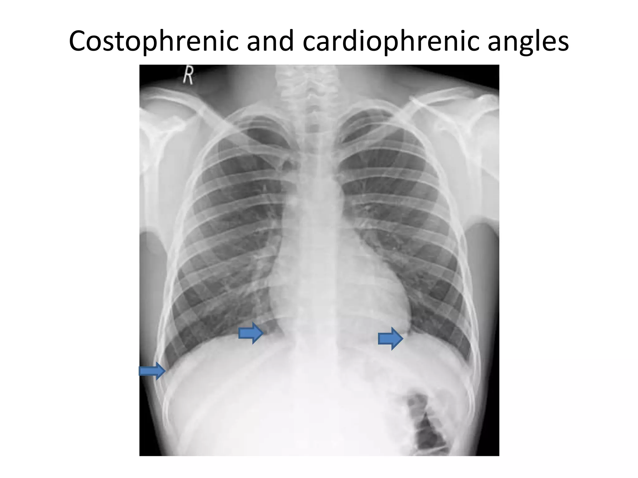 Chest xrays | PPTX