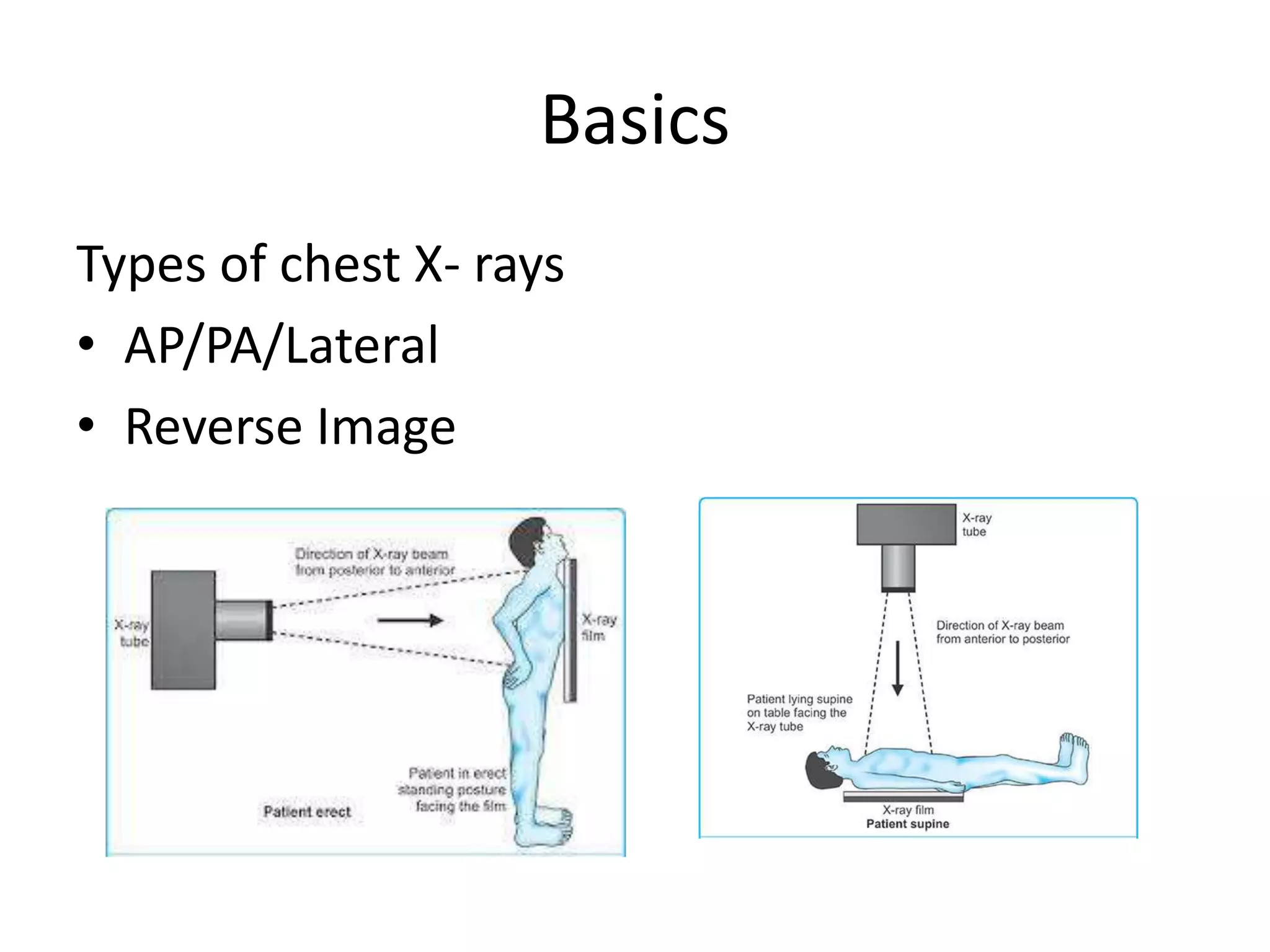 Chest xrays | PPTX