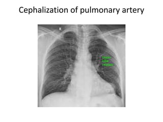 Cephalization Of Pulmonary Vessels
