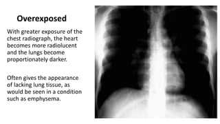 Chest X rays.pptx