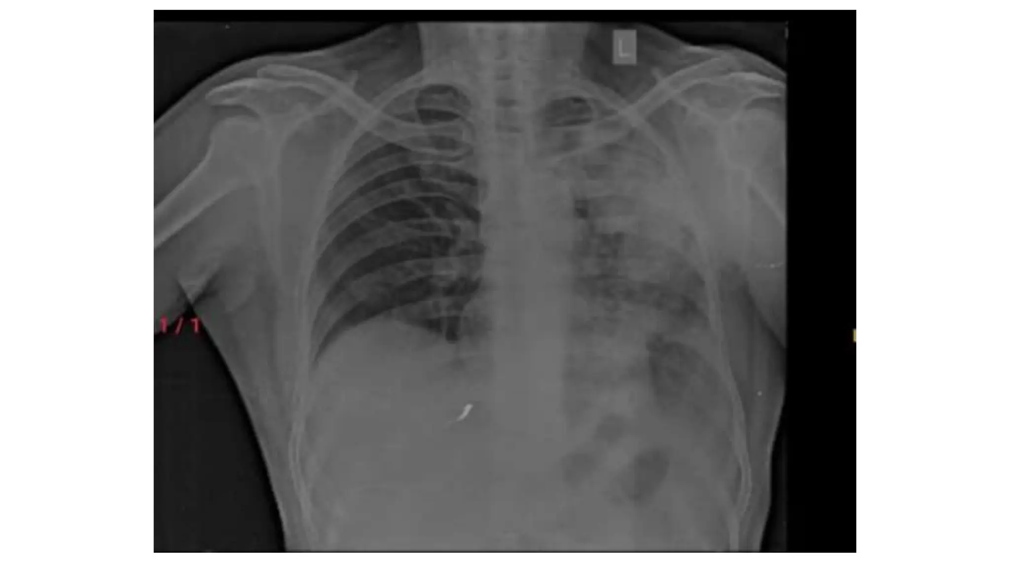 chest x rays for respiratory medicine pgs | PPT