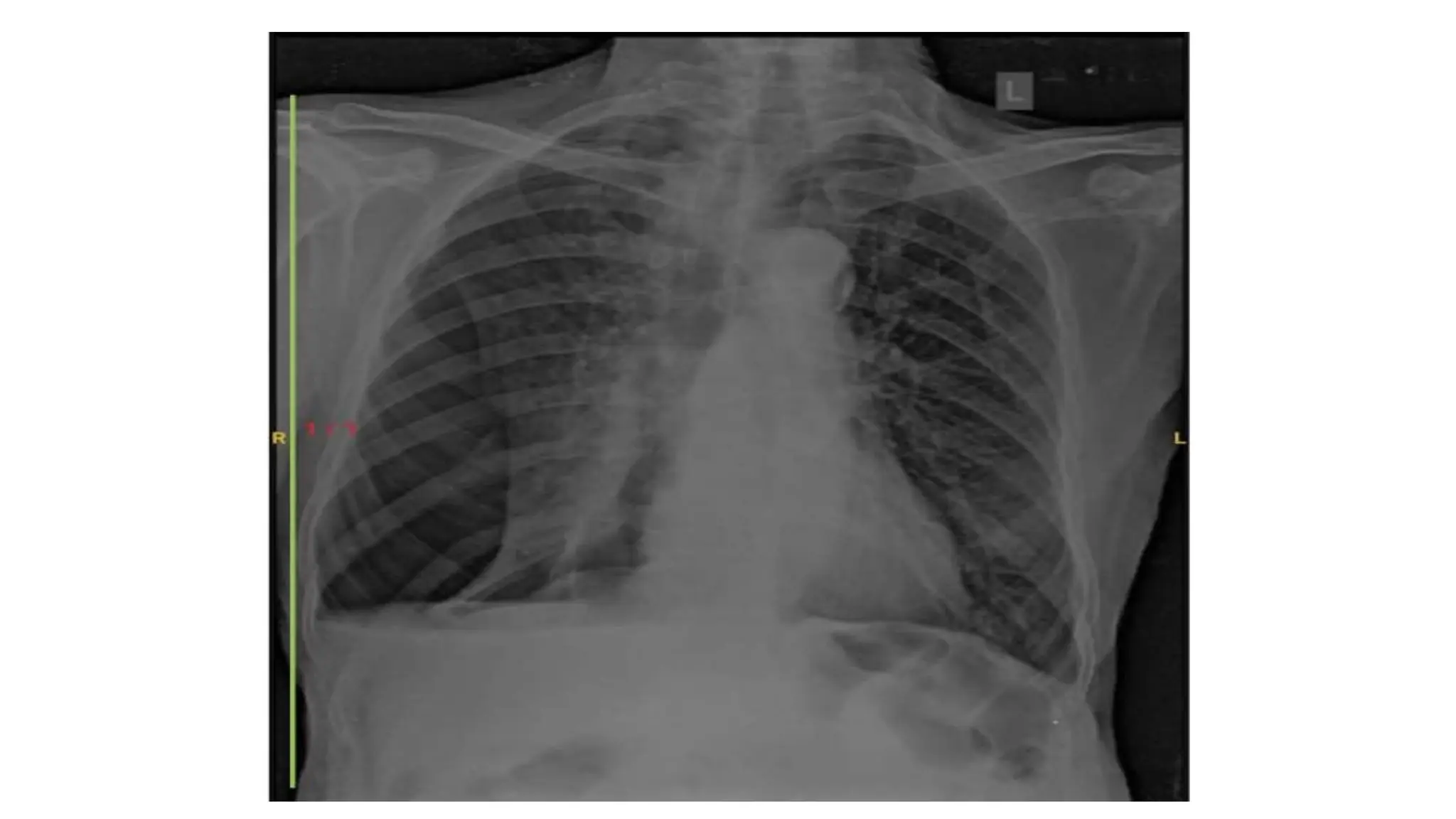 chest x rays for respiratory medicine pgs | PPT