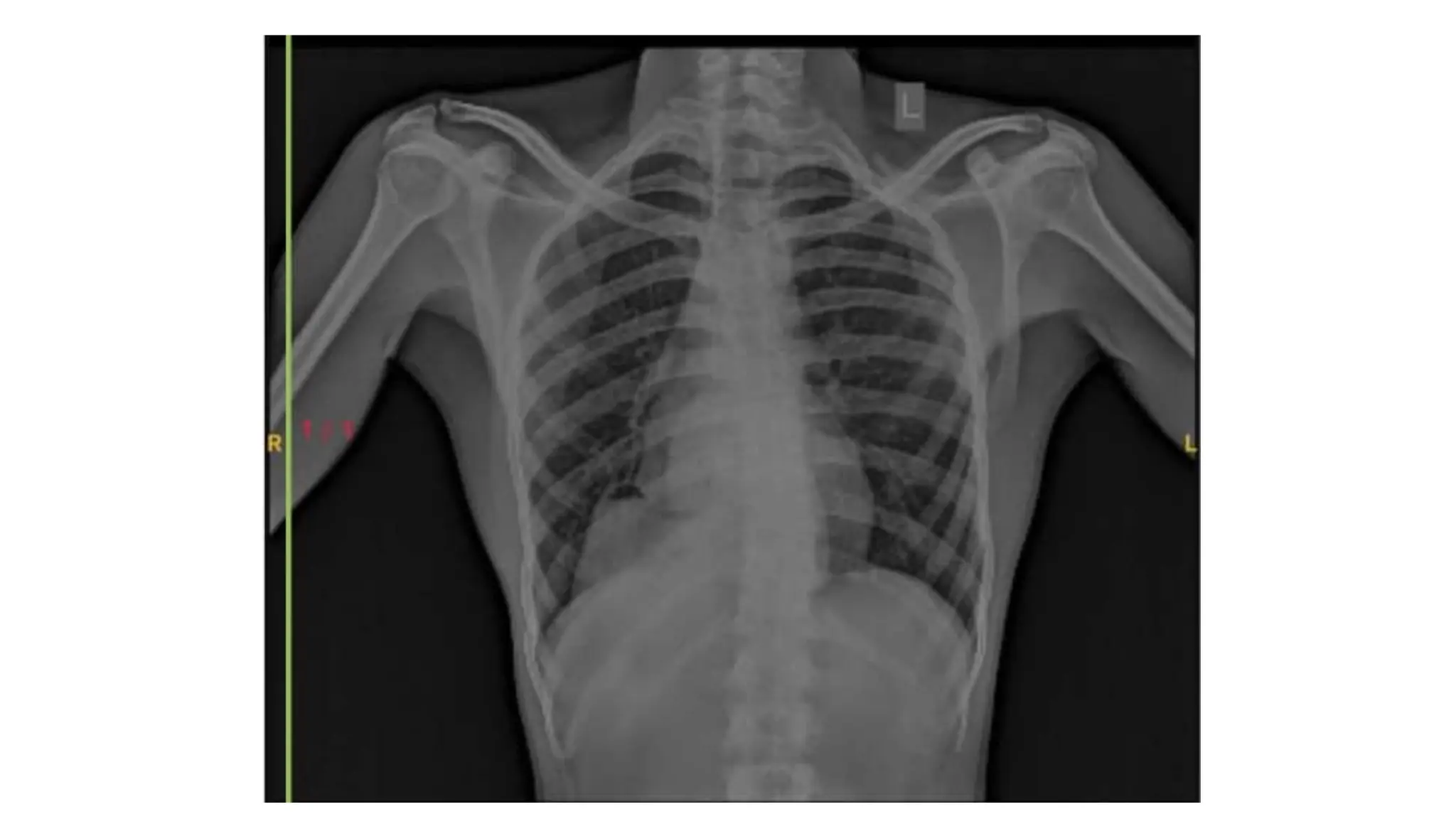 chest x rays for respiratory medicine pgs | PPT