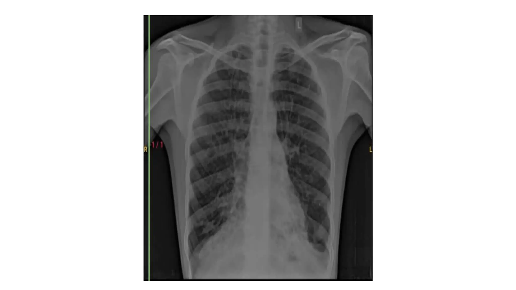 chest x rays for respiratory medicine pgs | PPT
