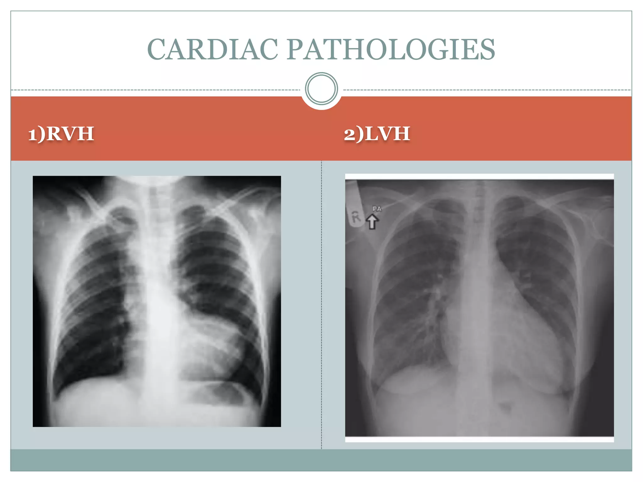 Chest X Rays | PPT