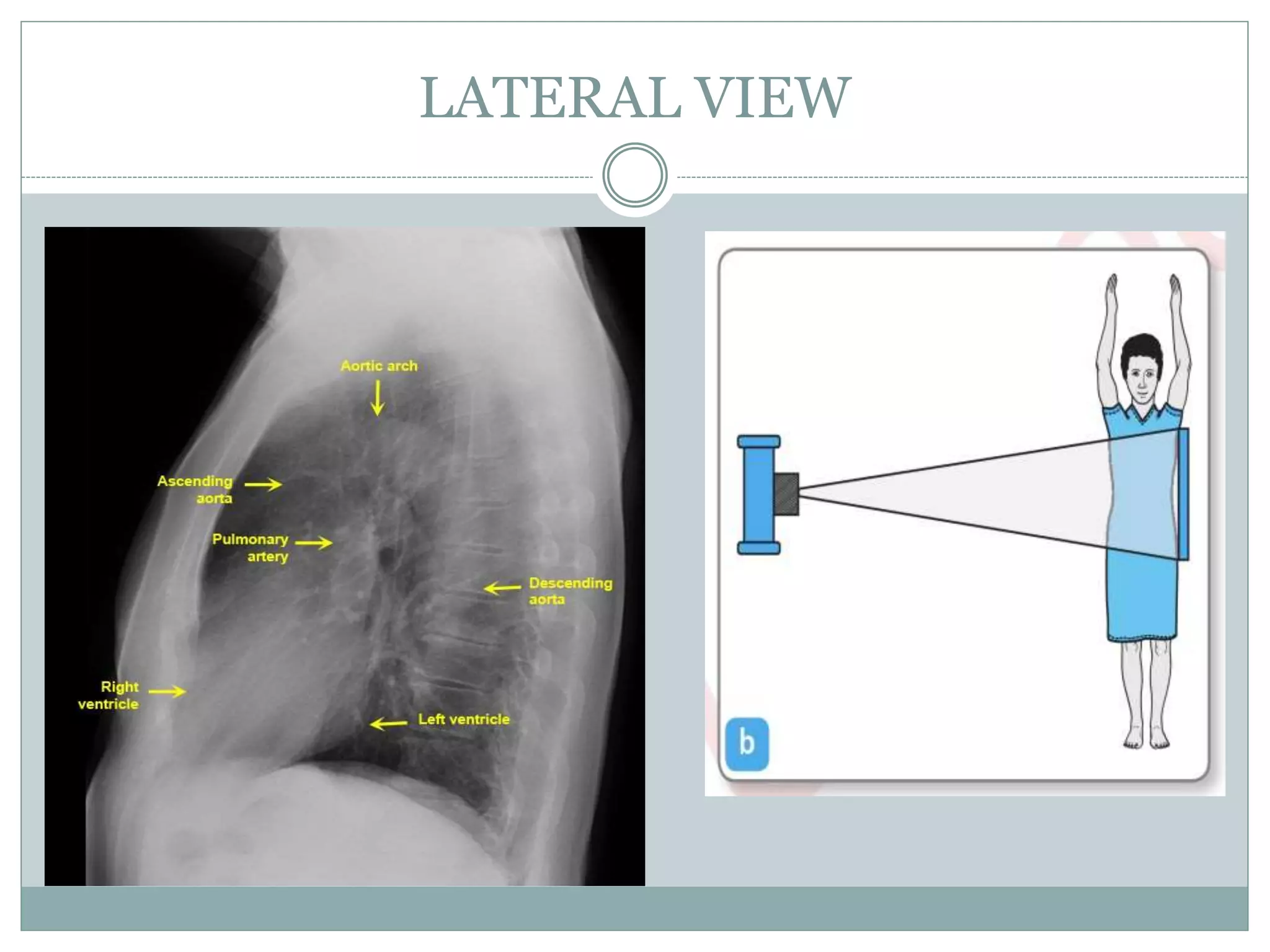 Chest X Rays | PPT