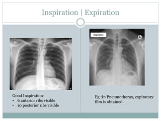 Chest X Rays | PPTX