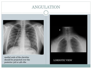Chest X Rays | PPTX