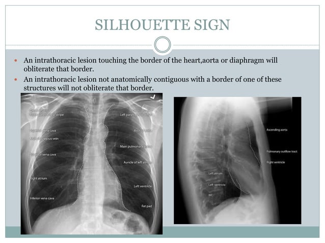 Chest X Rays | PPT