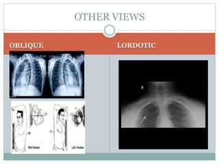 Chest X Rays | PPTX