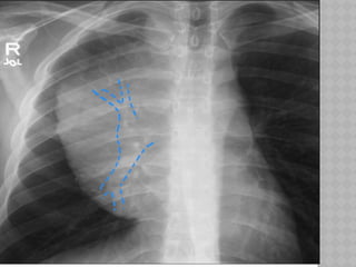some important chest xray signs in radiography.pptx