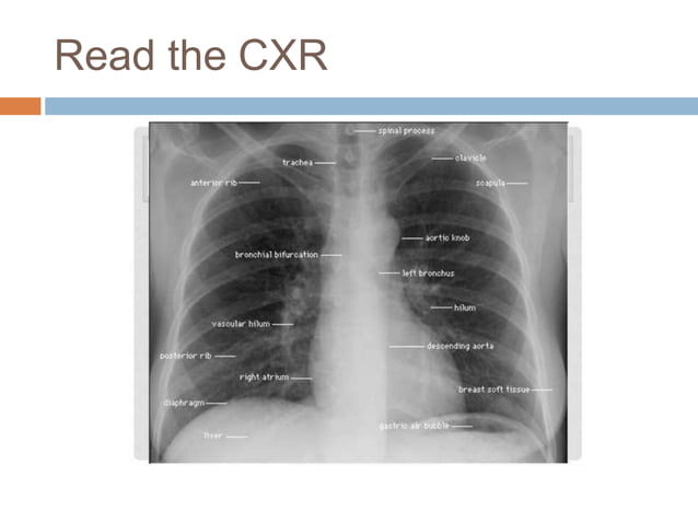 CHEST XRAYS RJJ.pptx