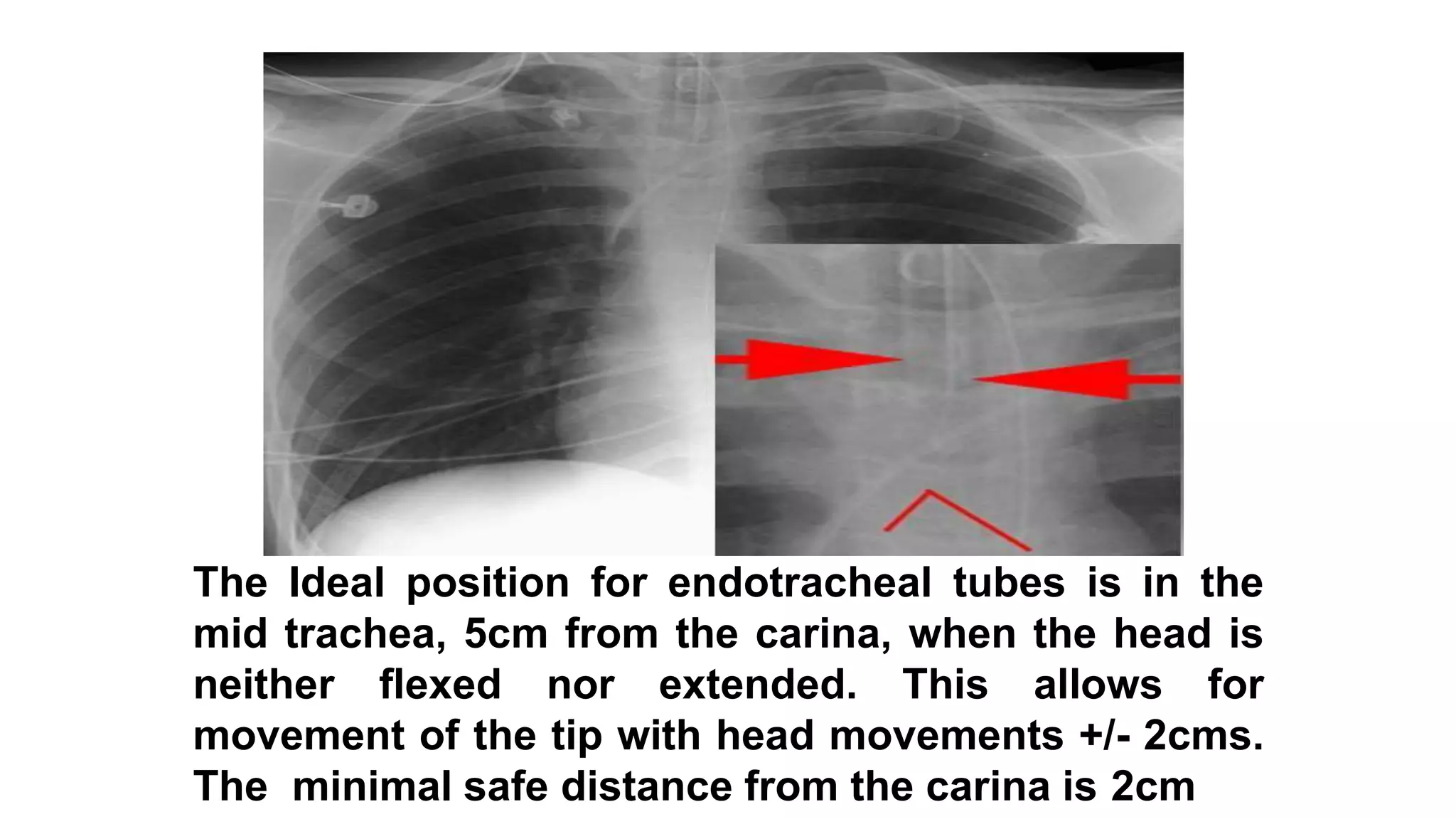 Chest x rays swati | PPTX