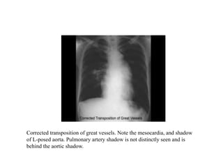 Waterfall Sign X Ray