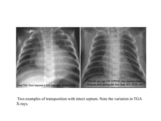 Waterfall Sign X Ray