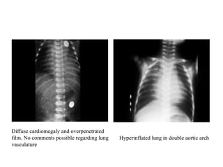 Waterfall Sign X Ray