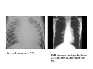 Waterfall Sign X Ray