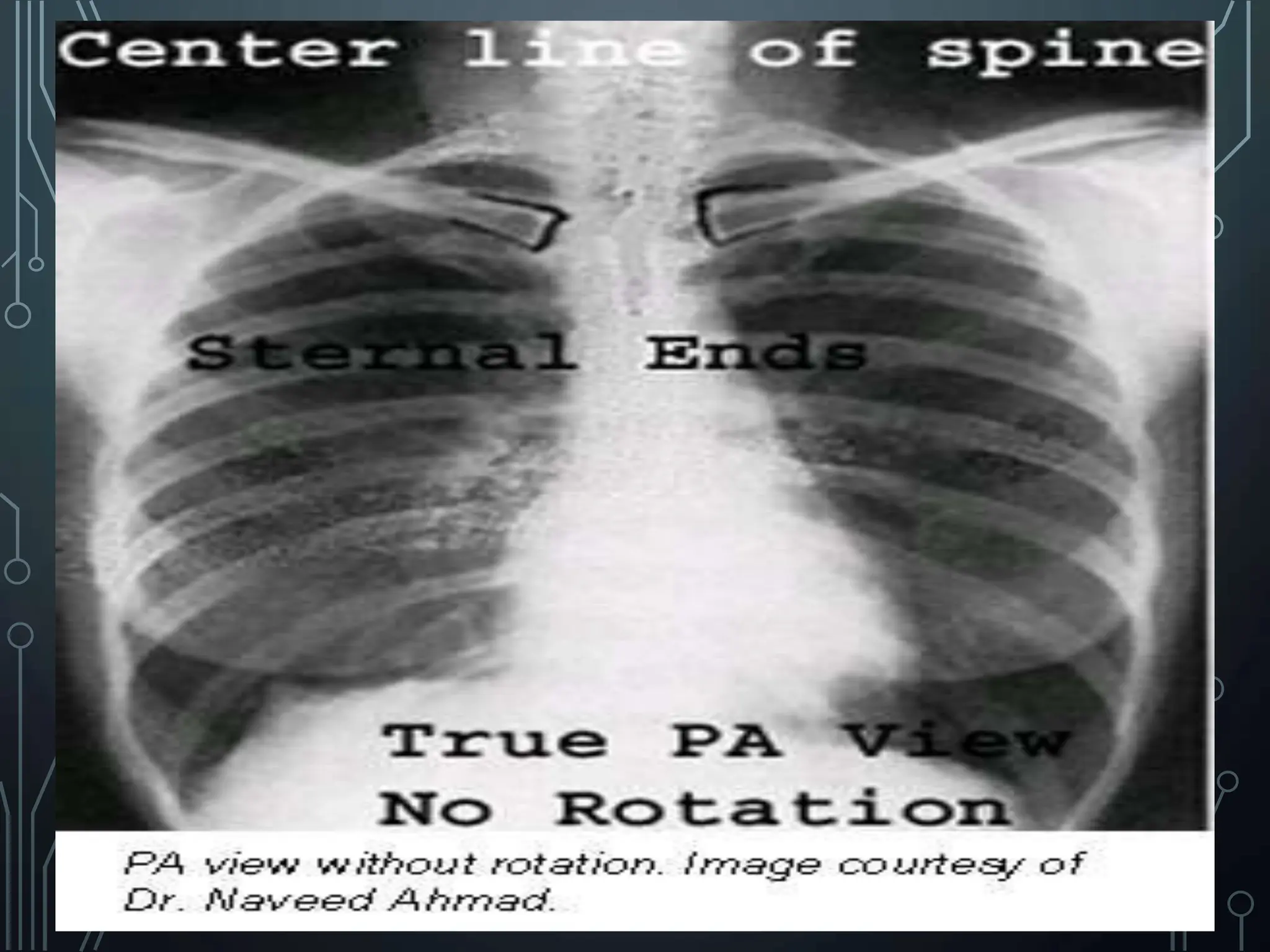 Basic Chest X ray Views - AP, PA & Lateral etc . pptx | PPTX