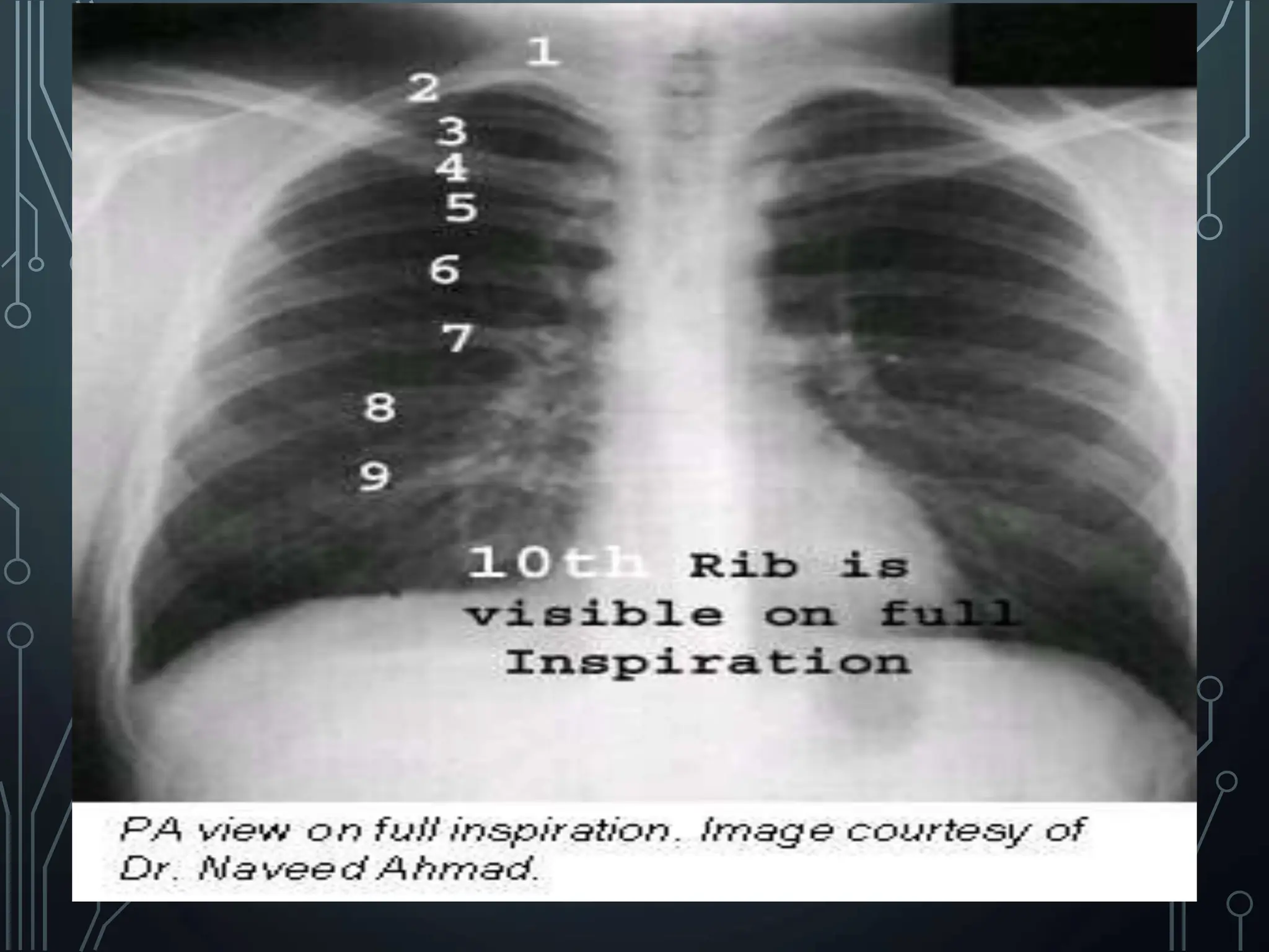 Basic Chest X ray Views - AP, PA & Lateral etc . pptx | PPTX