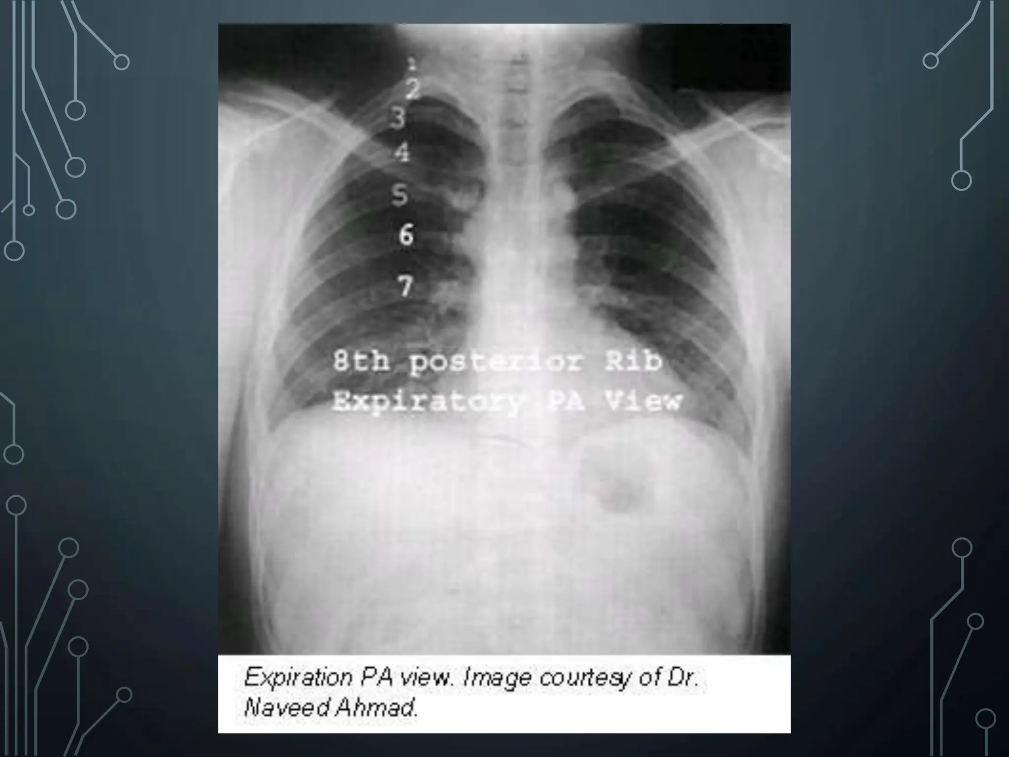 Basic Chest X ray Views - AP, PA & Lateral etc . pptx | PPTX