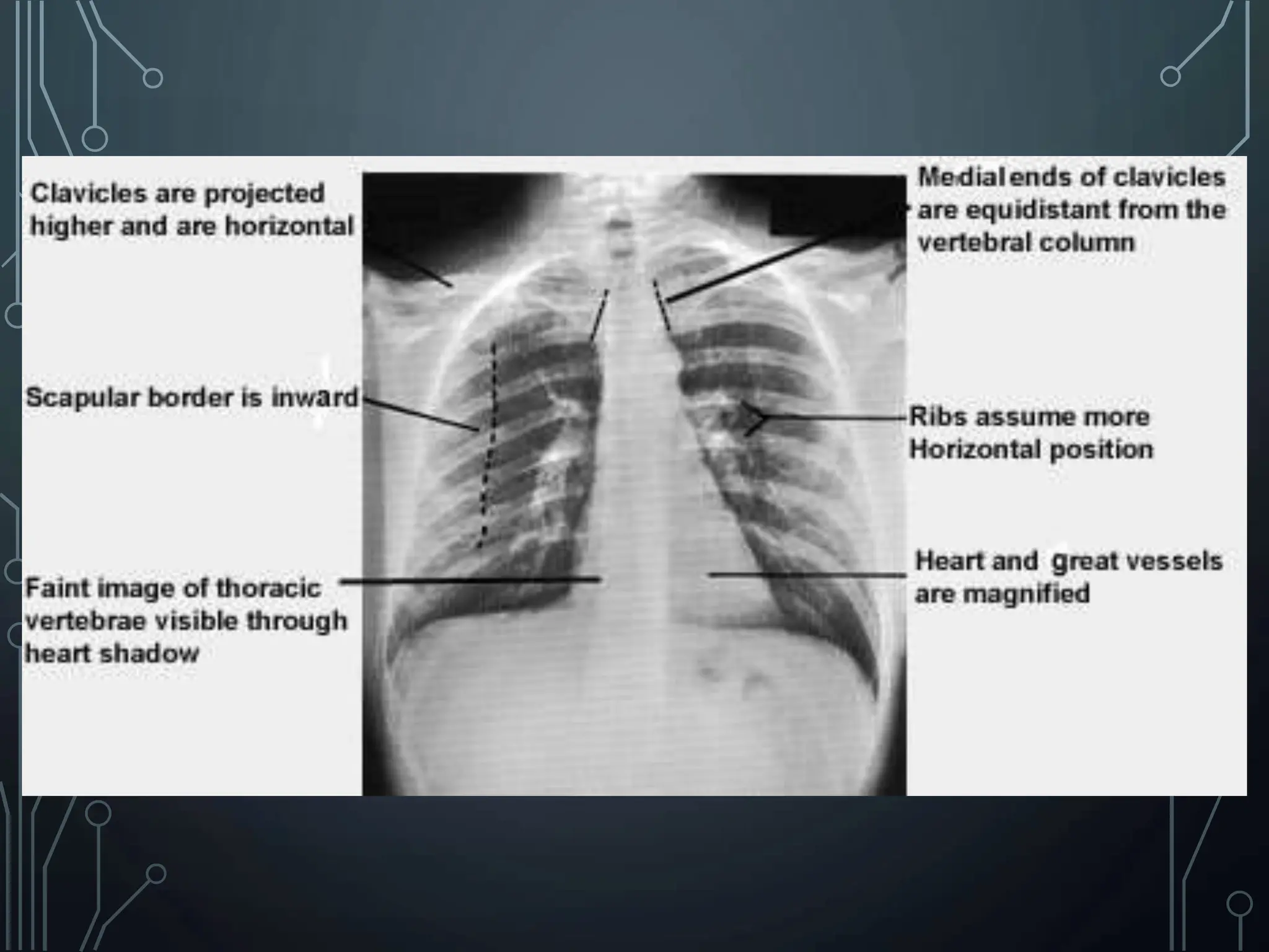 Basic Chest X ray Views - AP, PA & Lateral etc . pptx | PPTX